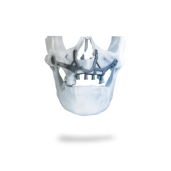 Subperiosteal Implant - Farinroshaan Teb
